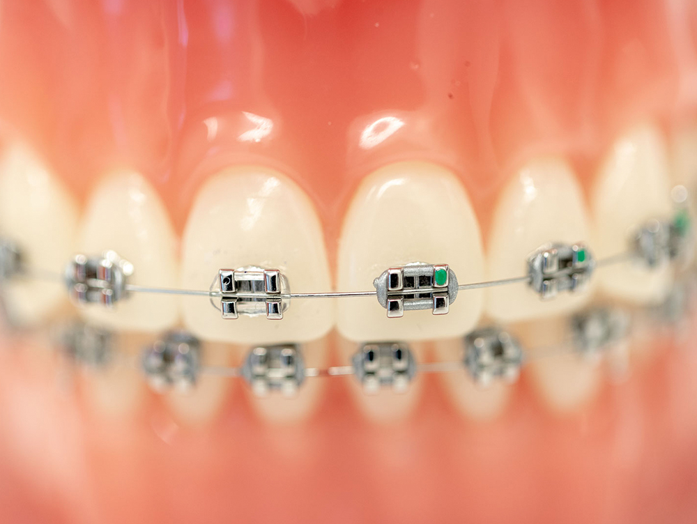 Feste Zahnspangen | Dr. Raphael Hoehr - Kieferorthopäde Borken - Dr ...